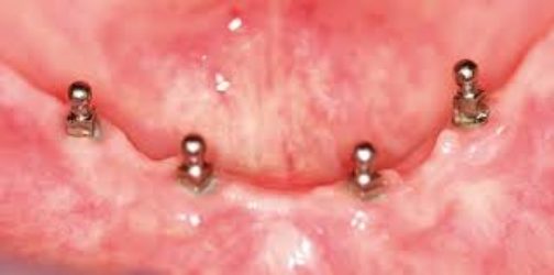 Mini-Implantate - Zahnarztpraxis Dr. Glatz